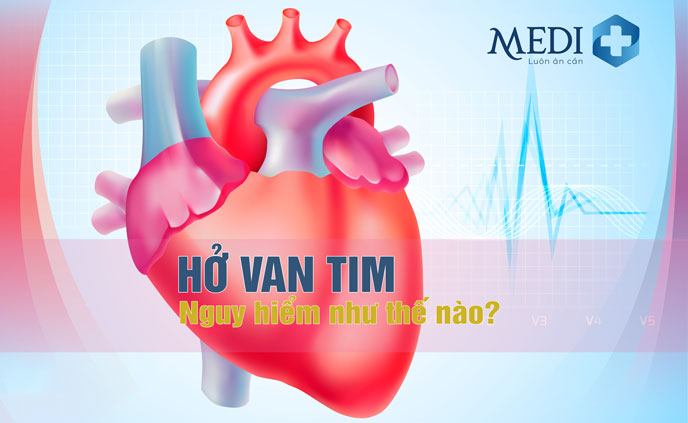 Hở van tim là gì? Bệnh có nguy hiểm không và có chữa được?