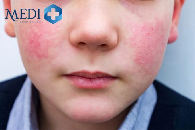 Hình ảnh bệnh lupus ban đỏ với các vết loét trên người