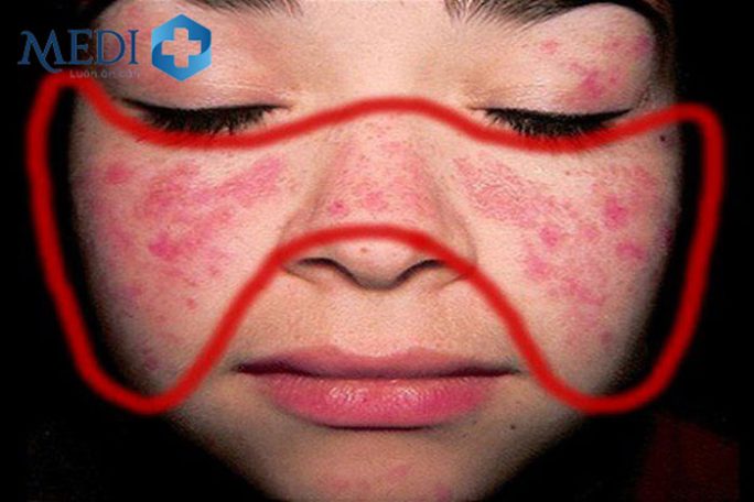 Hình ảnh bệnh lupus ban đỏ với các vết loét trên người