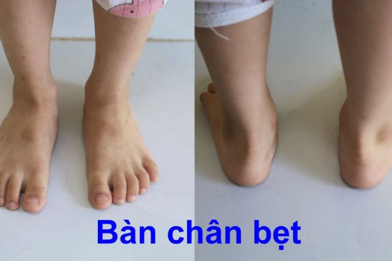 Bàn chân bẹt ở trẻ: 6 Nguyên nhân và 3 Cách điều trị
